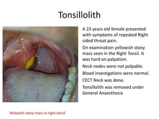 A giant tonsillolith | PPTX