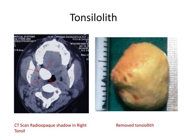 A giant tonsillolith | PPTX