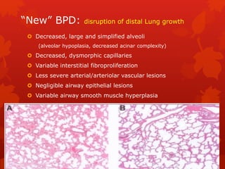 A glance at BPD | PPTX