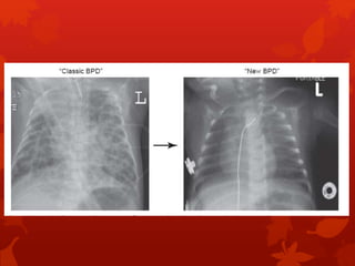 A glance at BPD | PPTX | Lung and Respiratory Health | Diseases and ...