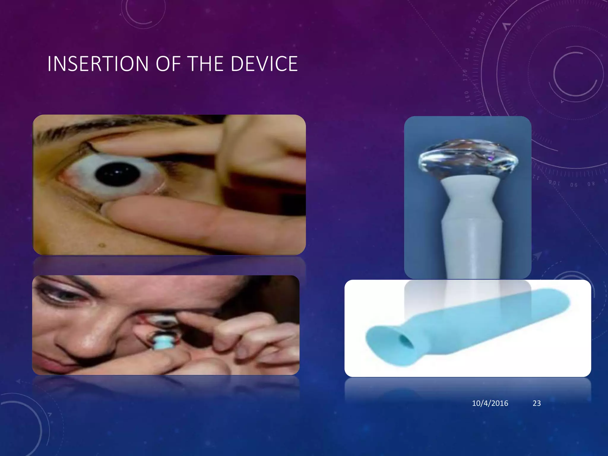 A glimpse through scleral contact lenses (PROSE) | PPTX