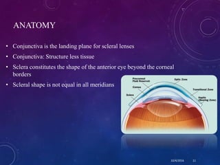 A glimpse through scleral contact lenses (PROSE) | PPTX