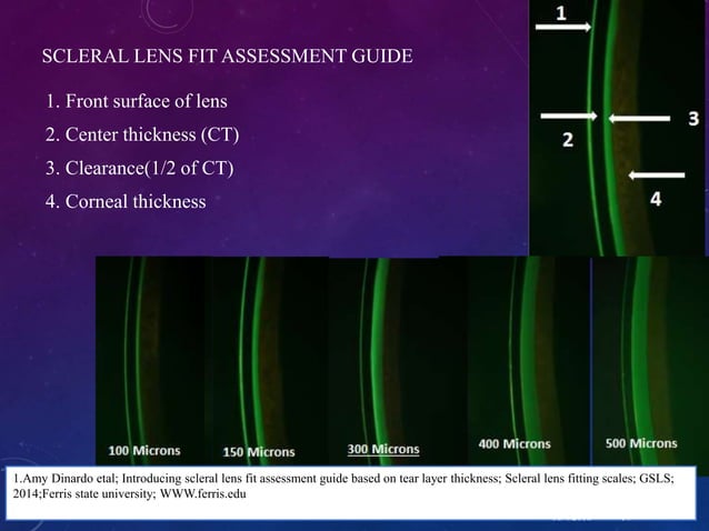 A glimpse through scleral contact lenses (PROSE) | PPTX