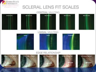 A glimpse through scleral contact lenses (PROSE) | PPTX