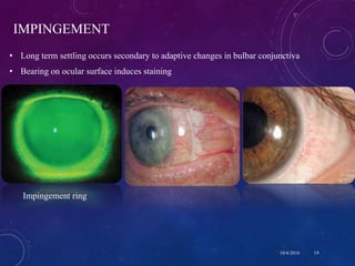 A glimpse through scleral contact lenses (PROSE) | PPTX