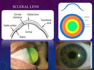 A glimpse through scleral contact lenses (PROSE) | PPT