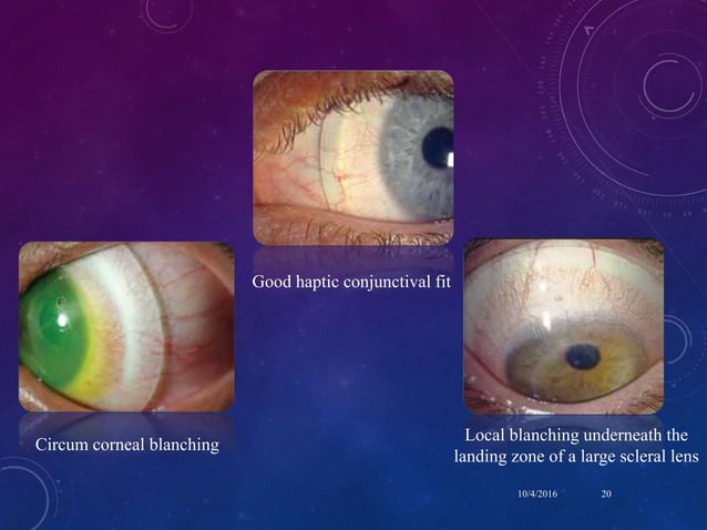 A glimpse through scleral contact lenses (PROSE) | PPTX