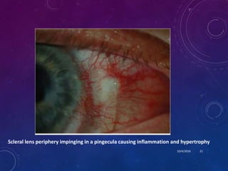 A glimpse through scleral contact lenses (PROSE) | PPT