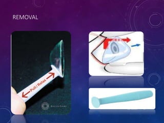 A glimpse through scleral contact lenses (PROSE) | PPT