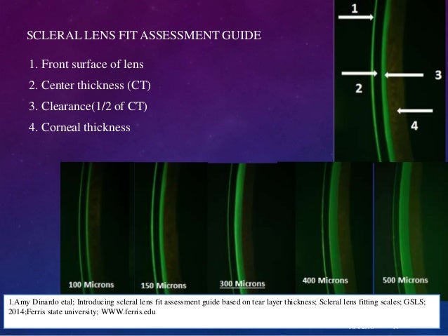 A glimpse through scleral contact lenses (PROSE)