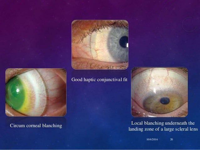 A glimpse through scleral contact lenses (PROSE)