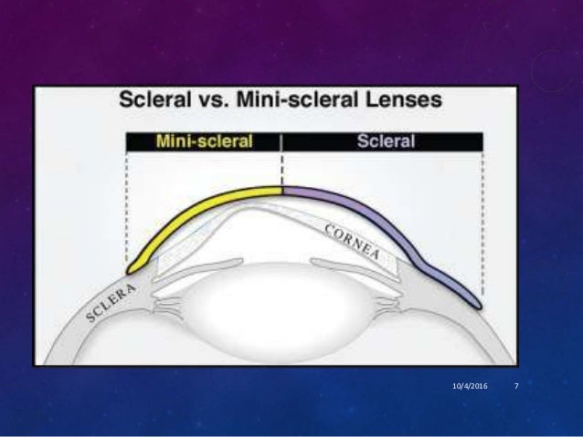 A glimpse through scleral contact lenses (PROSE)