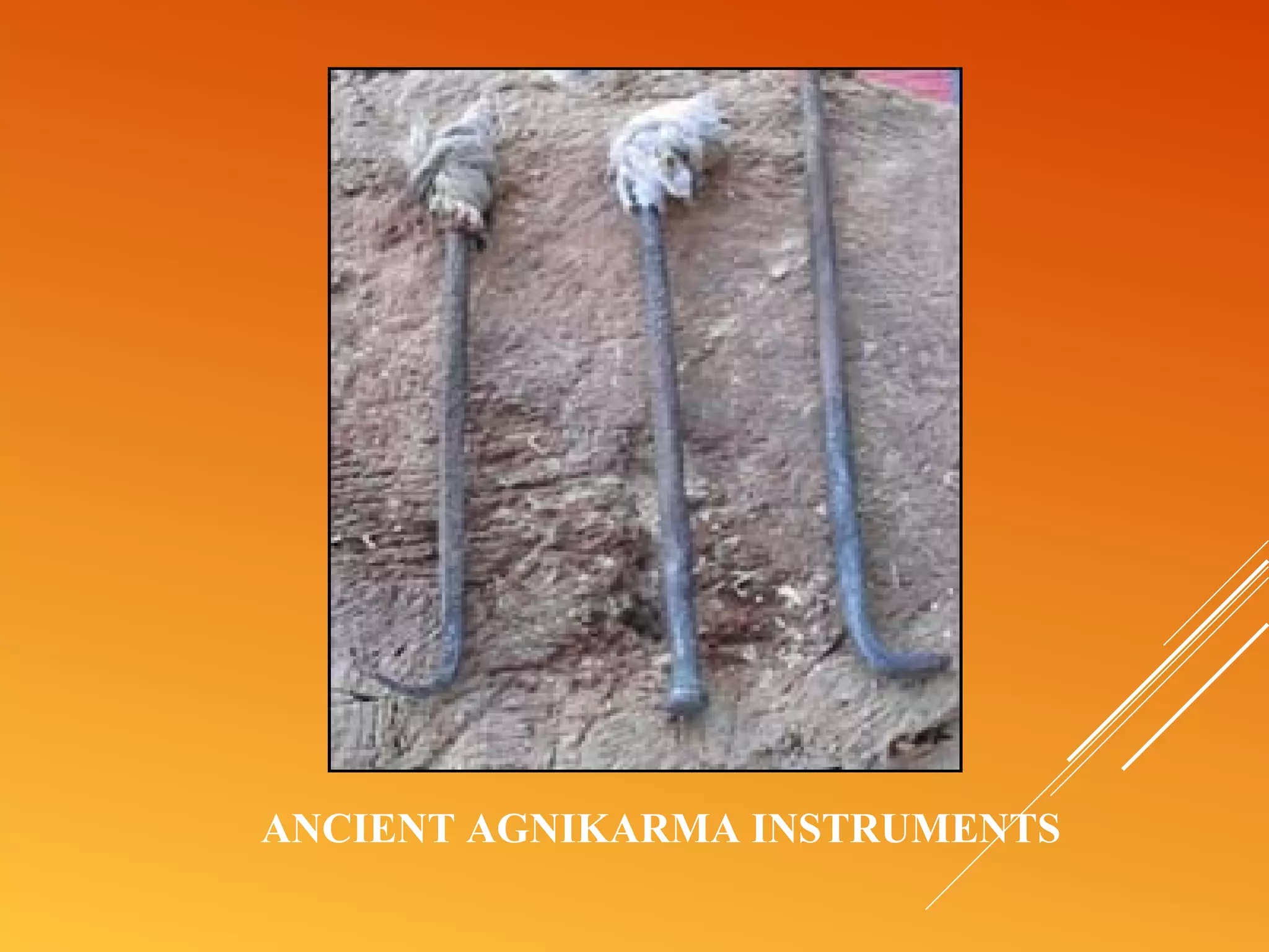 Agnikarma (An Ancient Ayurvedic Therapy) - Benefits, Indications and ...