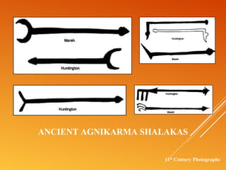 Agnikarma (An Ancient Ayurvedic Therapy) - Benefits, Indications and ...