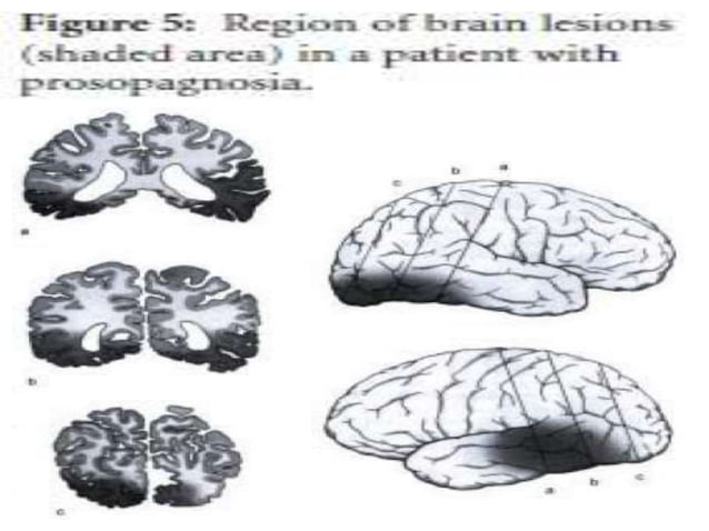 Agnosia ppt | PPTX | Brain and Nervous System Disorders | Diseases and ...