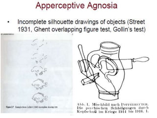 Apperceptive Agnosia
