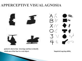 Apperceptive Agnosia