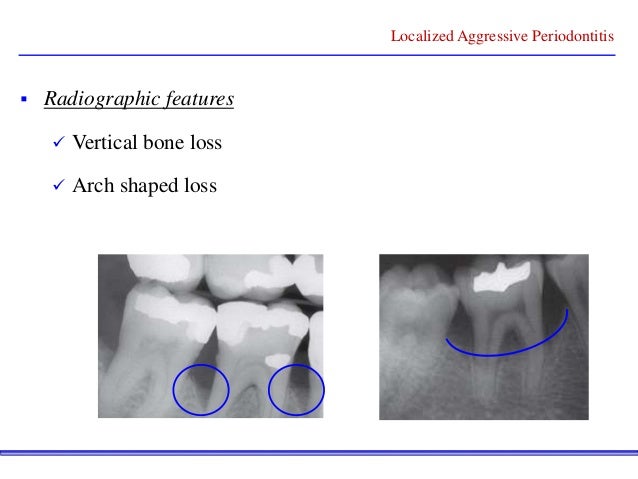 Aggressive periodontitis