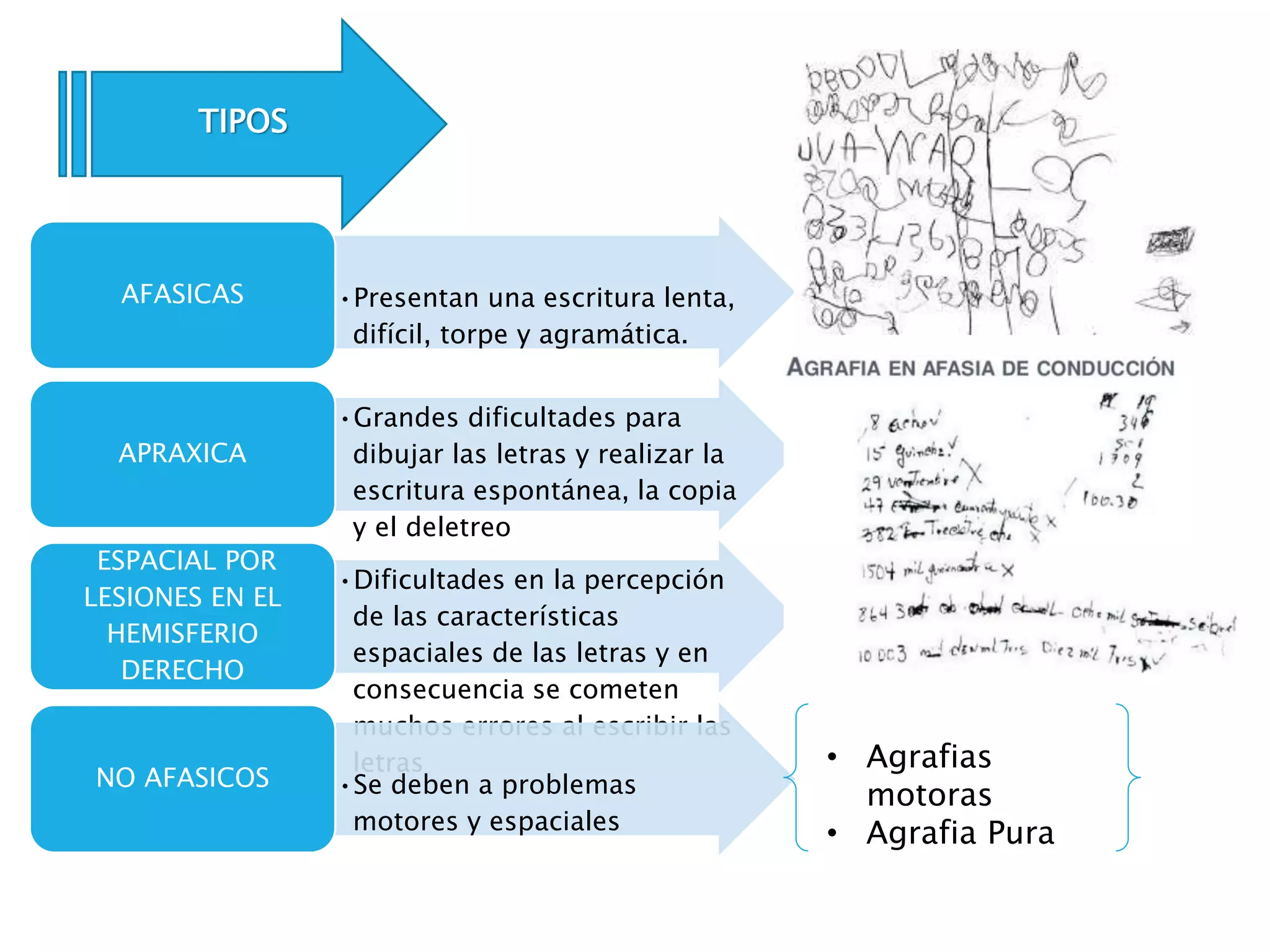 Agrafias diapositivas | PPTX | Brain and Nervous System Disorders ...