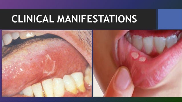Agranulocytosis by Dr. Sookun Rajeev Kumar