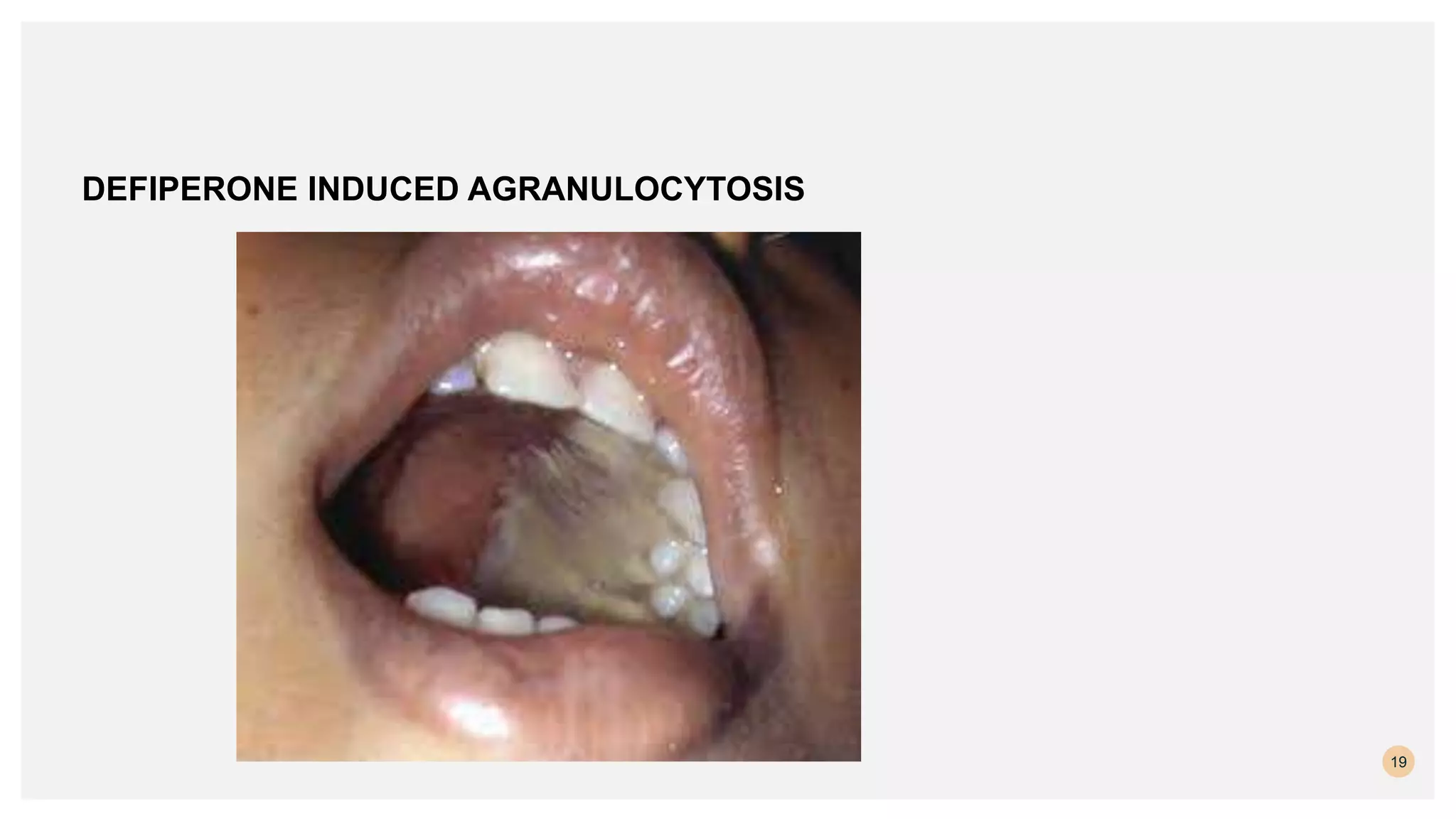 Agranulocytosis oral pathology | PPTX