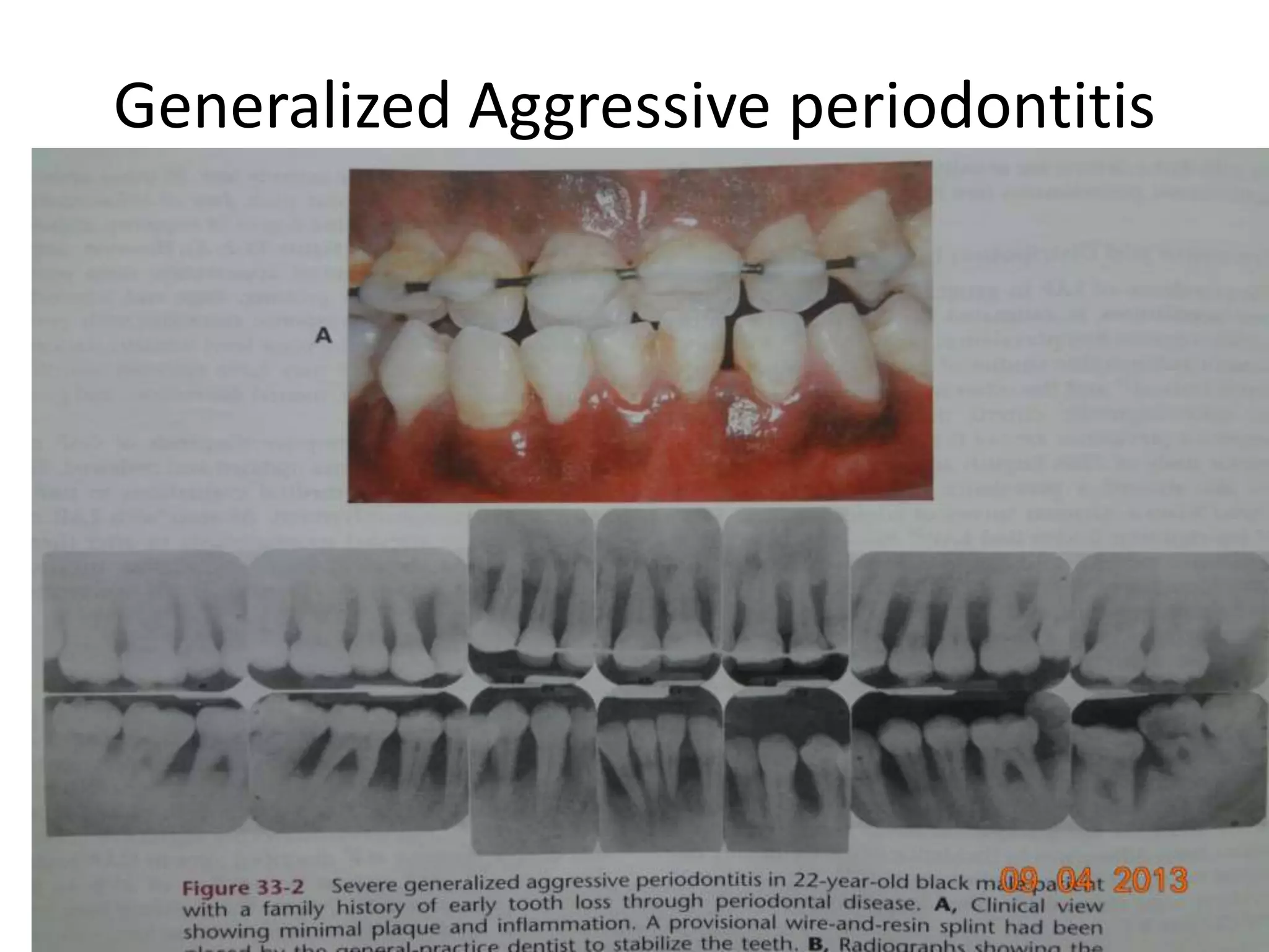 agressive periodontitis.pptx