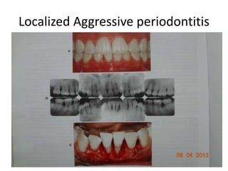agressive periodontitis.pptx