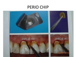 agressive periodontitis.pptx
