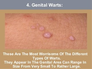 A Guide To Different Types Of Warts