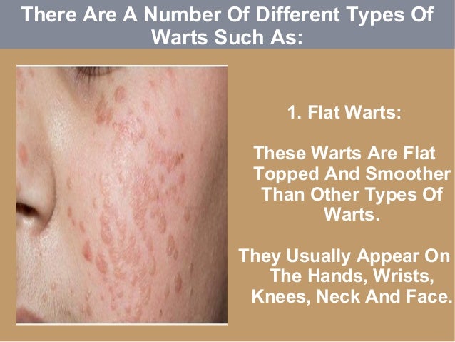 A Guide To Different Types Of Warts