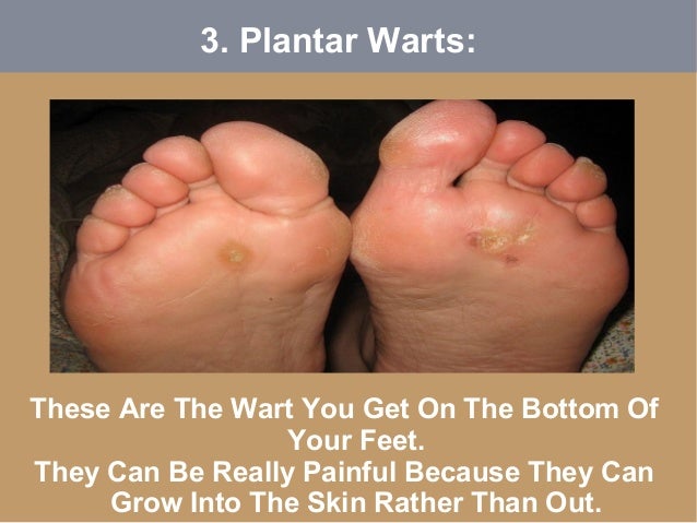 A Guide To Different Types Of Warts