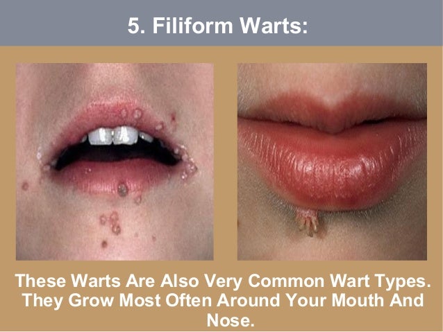 A Guide To Different Types Of Warts