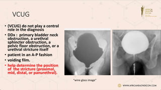 female anterior urethroplasty techniques | PPTX