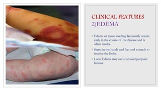 Acute Hemorrhagic edema of Infancy | PPT