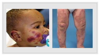 Acute Hemorrhagic Edema Of Infancy