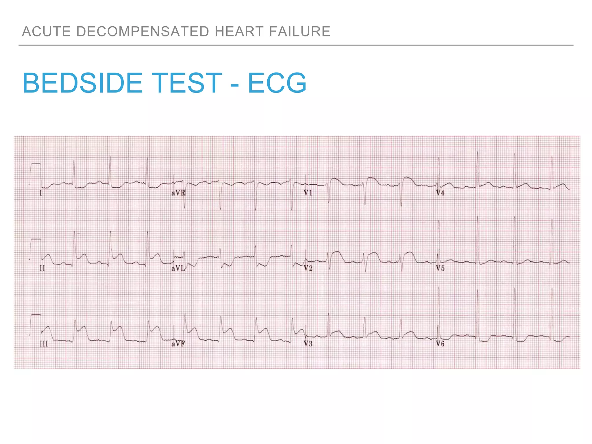 Acute Decompensated Heart Failure | PPTX