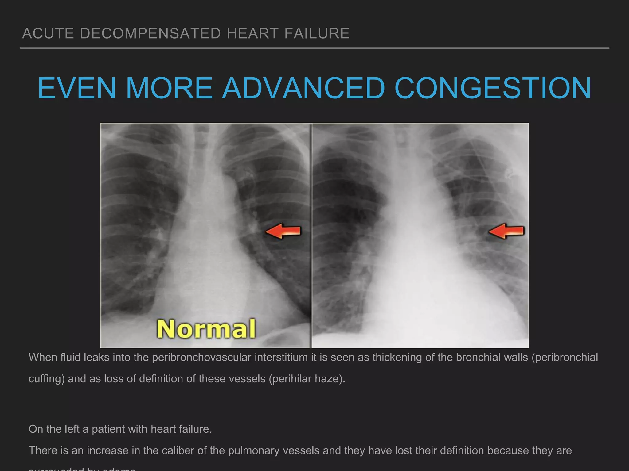 Acute Decompensated Heart Failure | PPTX