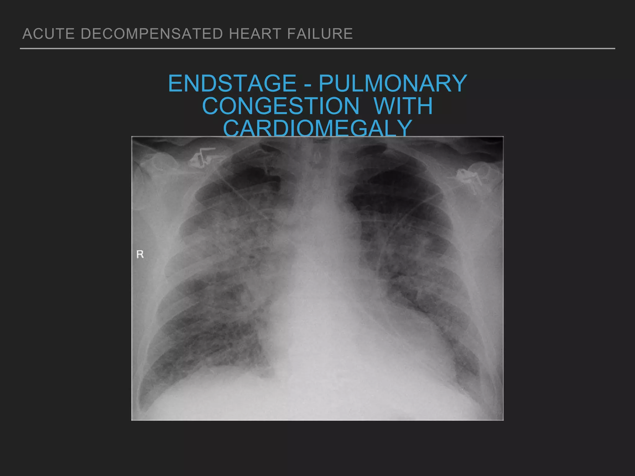 Acute Decompensated Heart Failure | PPTX