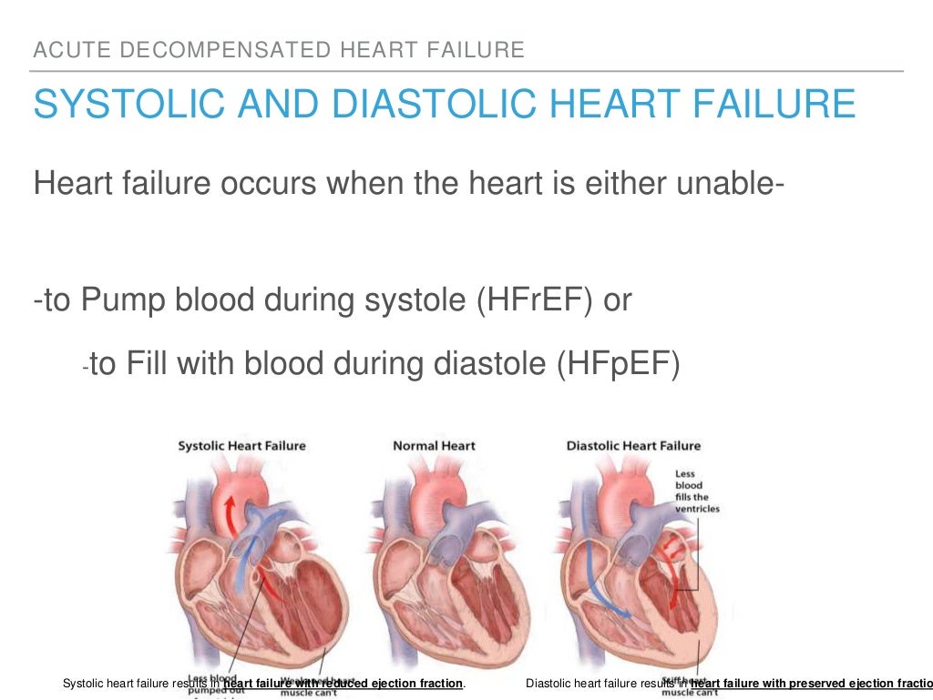 Acute Decompensated Heart Failure