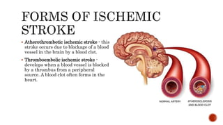 Ahmed Akeel - treatment of ischemic shock | PPTX