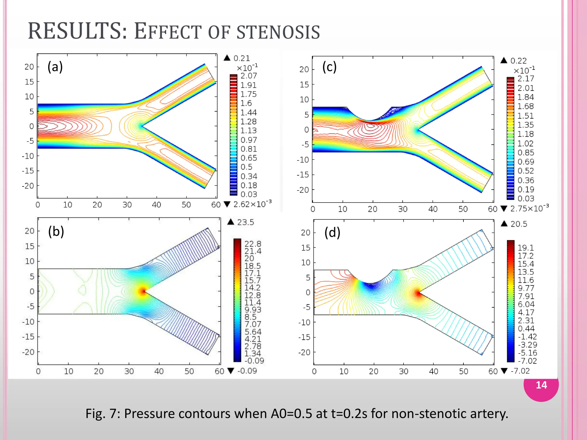 Computational simulation of blood flow in stenosed Arterial Bifurcation ...