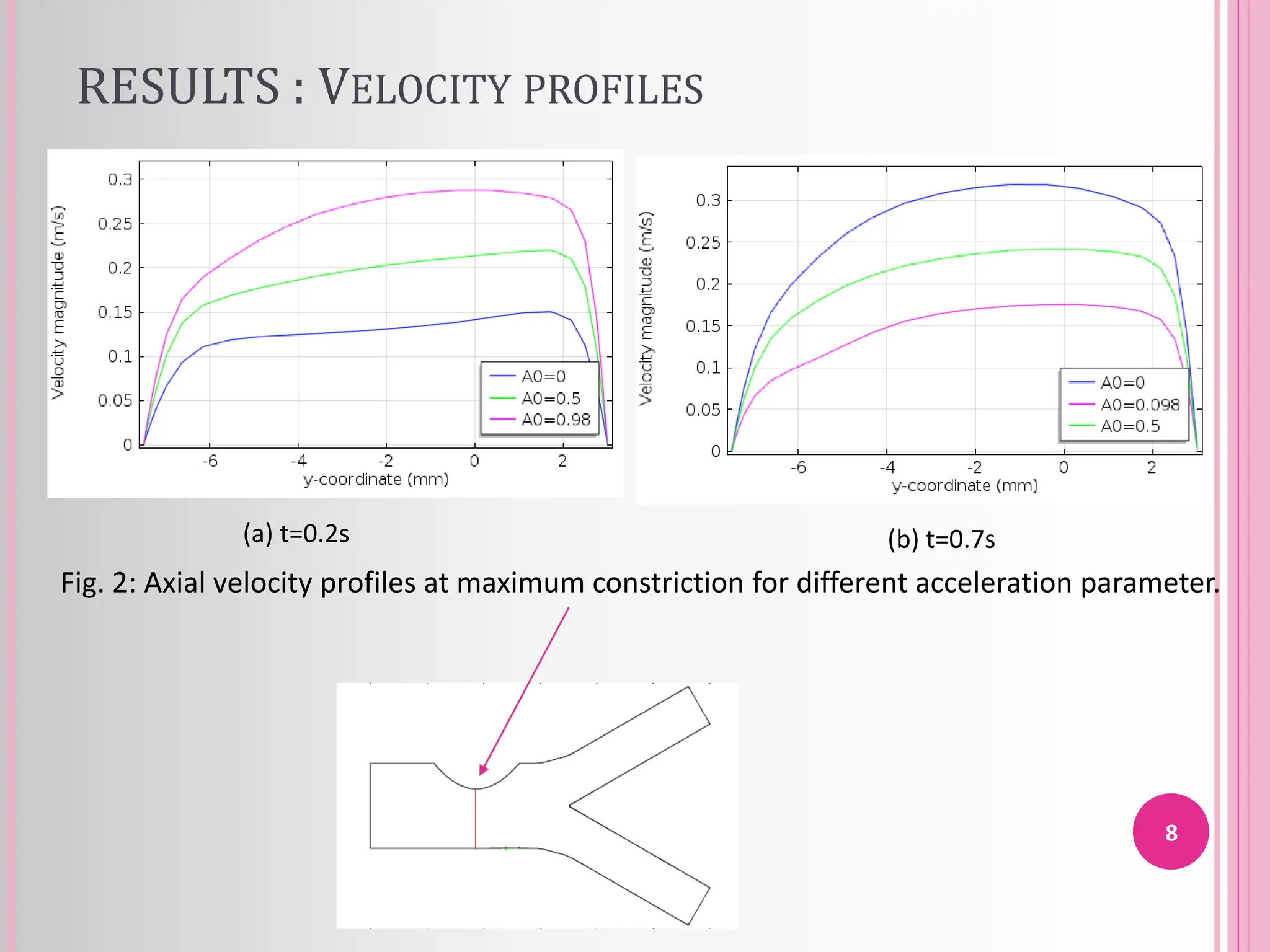 Computational simulation of blood flow in stenosed Arterial Bifurcation ...