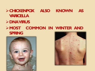 chickenpox (TSMU) | PDF | Infectious Diseases | Diseases and Conditions