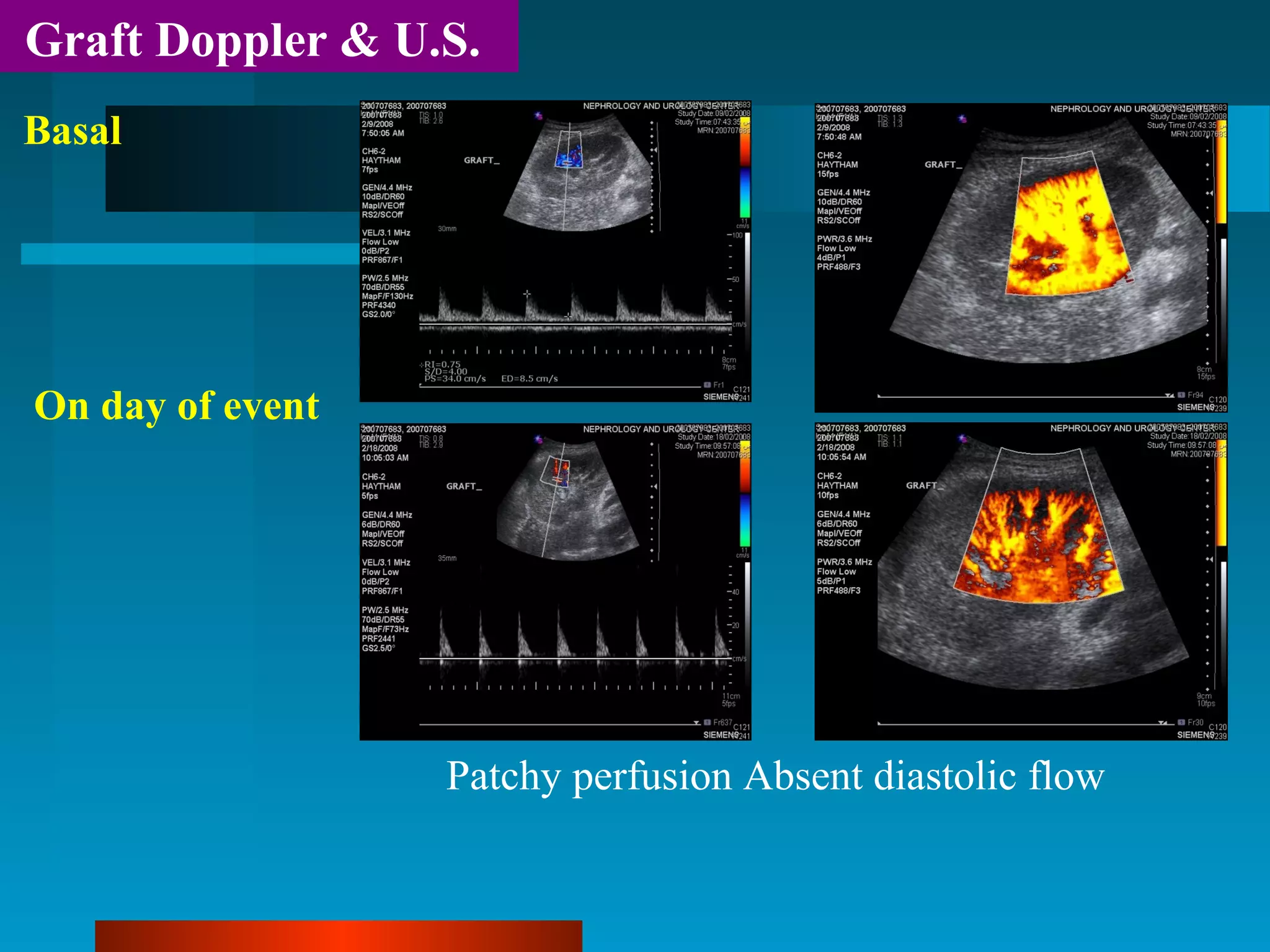 graft vein thrombosis after renal transplantation | PPT