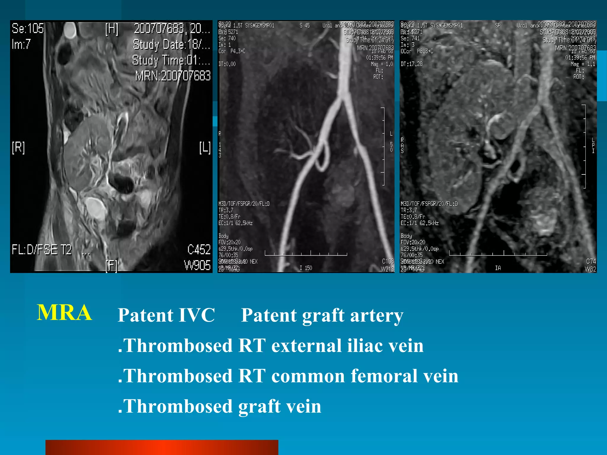 graft vein thrombosis after renal transplantation | PPT