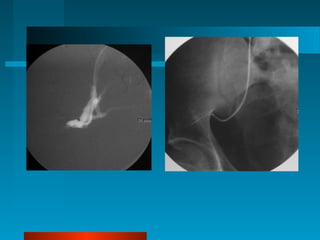 graft vein thrombosis after renal transplantation | PPT