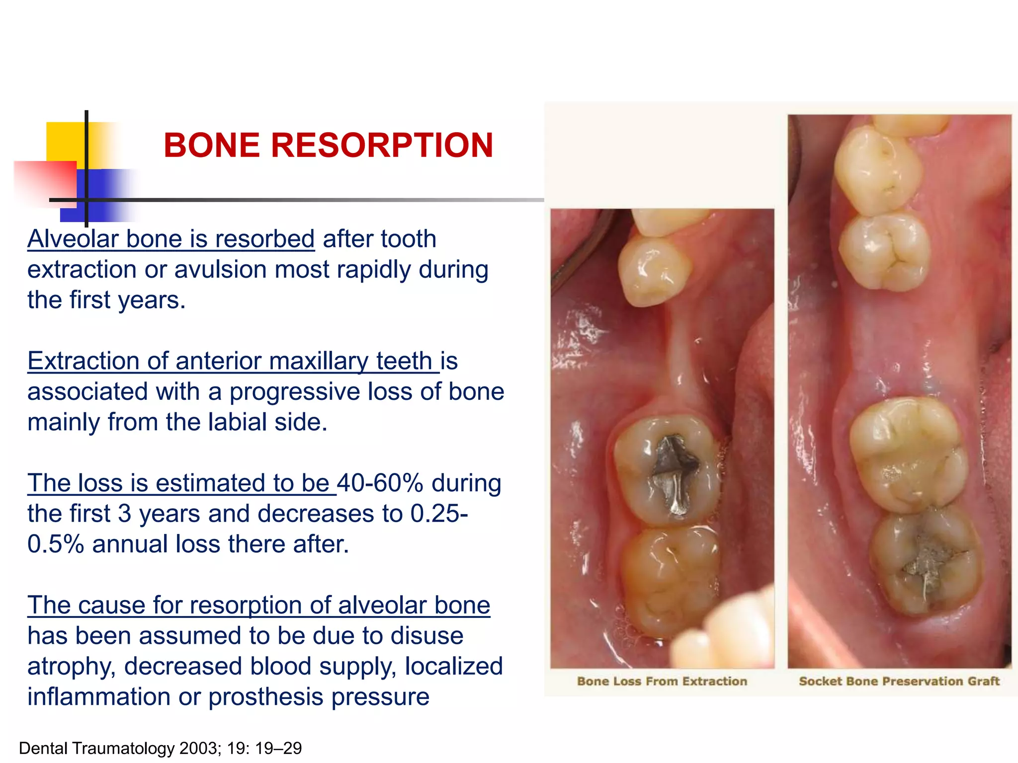 alveolar ridge expansion and socket preservation | PPT | Bone and Joint Conditions | Diseases ...