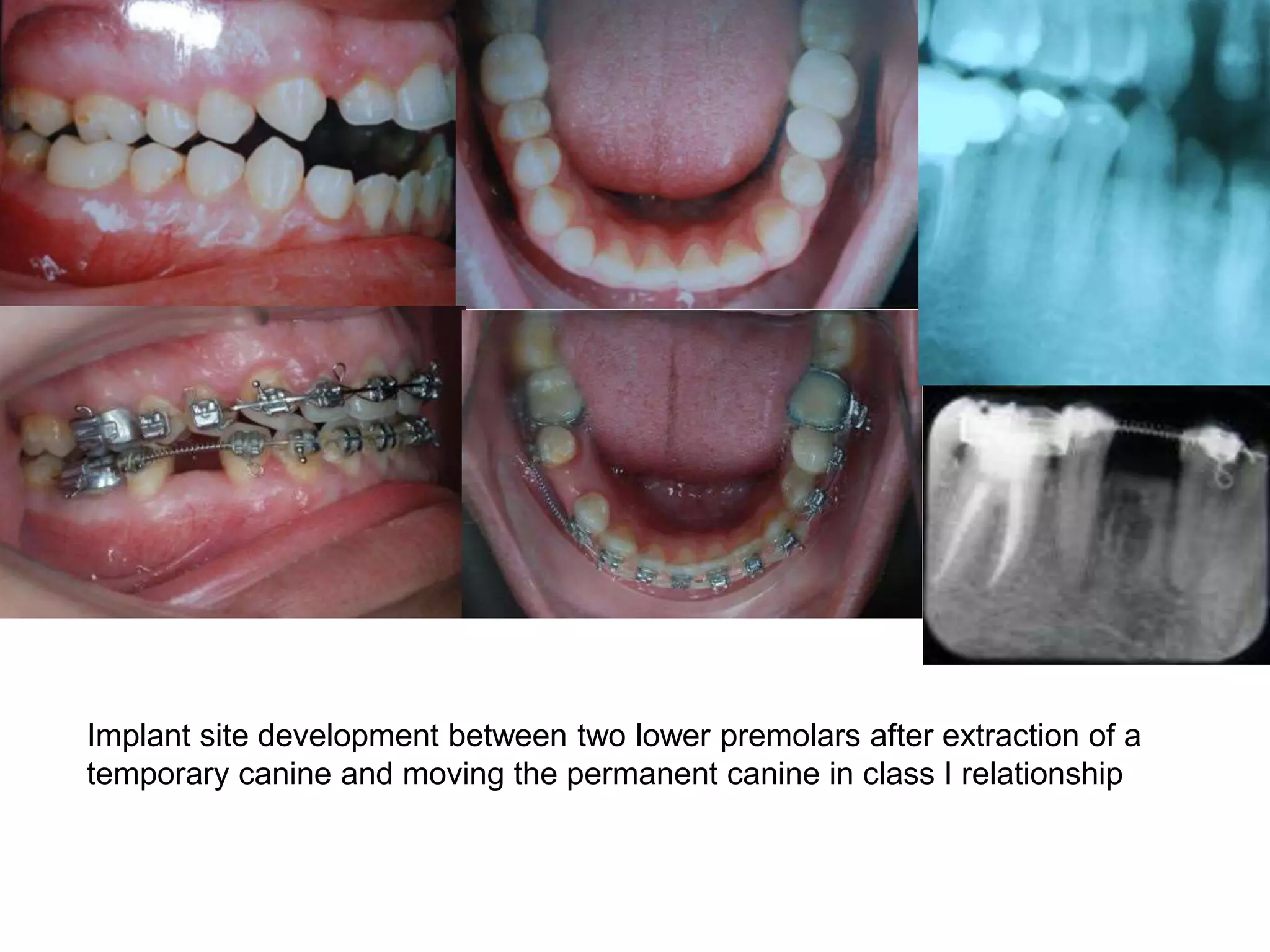 alveolar ridge expansion and socket preservation | PPT | Bone and Joint ...