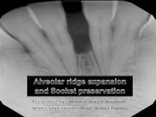 alveolar ridge expansion and socket preservation | PPT