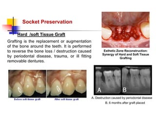 alveolar ridge expansion and socket preservation | PPT